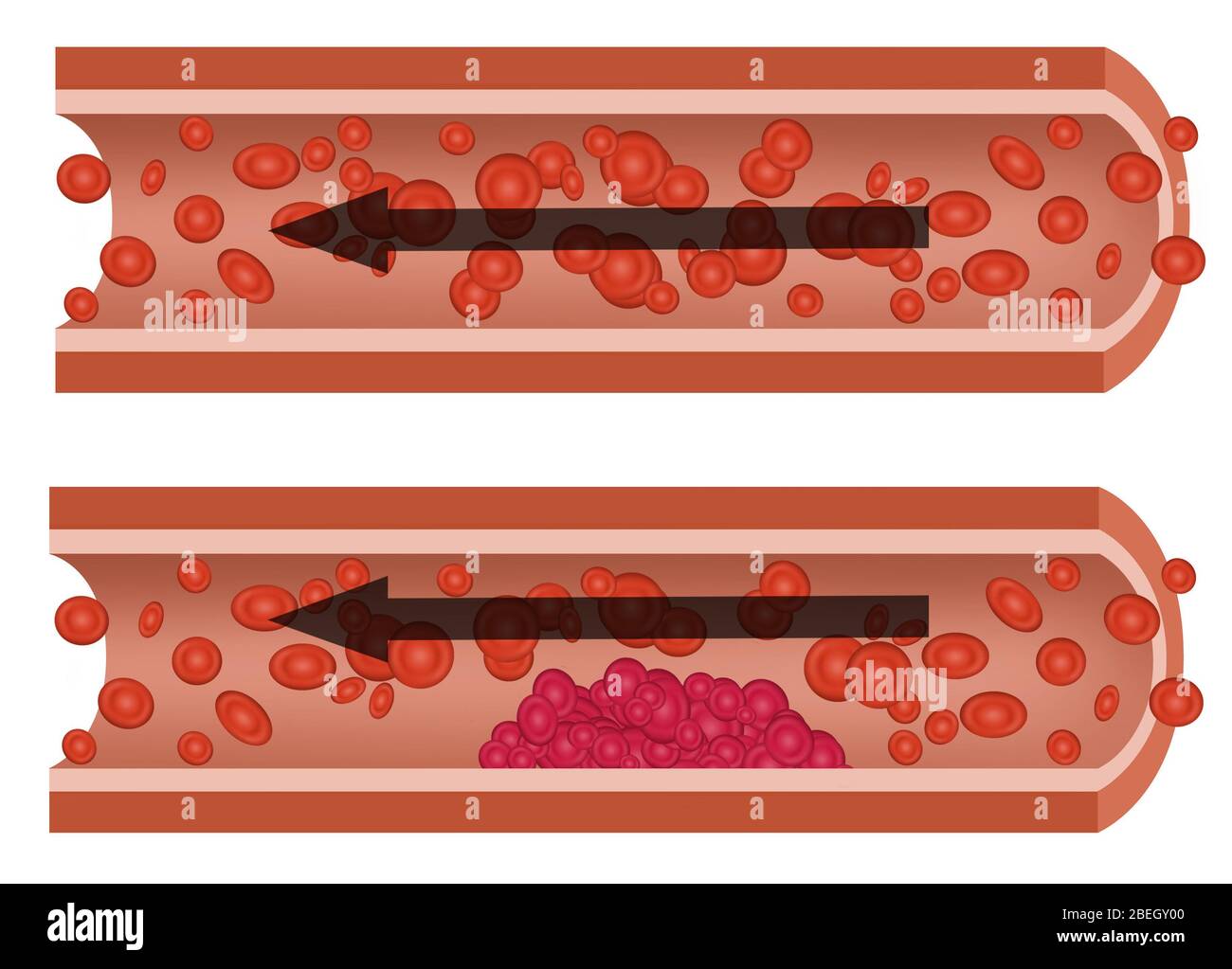 Artery blockage hi-res stock photography and images - Alamy