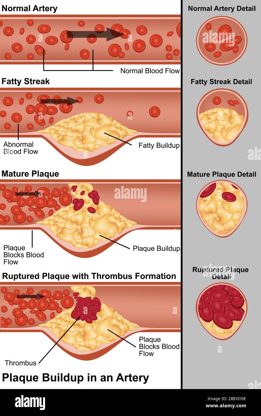 Plaque in Artery Stock Photo - Alamy