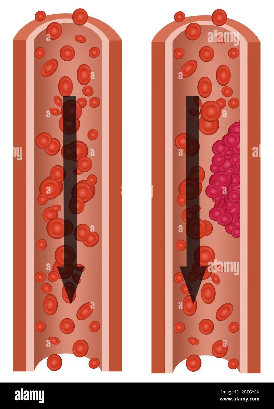 Artery blockage hi-res stock photography and images - Alamy