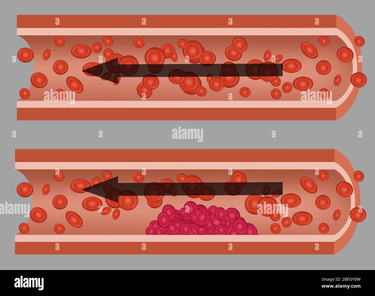 Healthy and Abnormal Blood Flow Stock Photo - Alamy