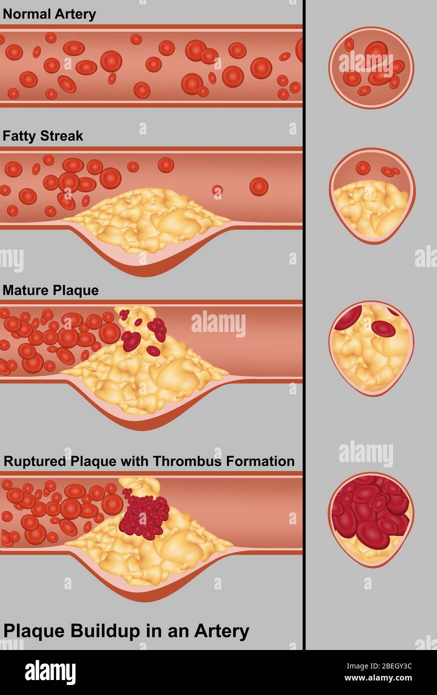 Artery Blockage High Resolution Stock Photography and Images - Alamy
