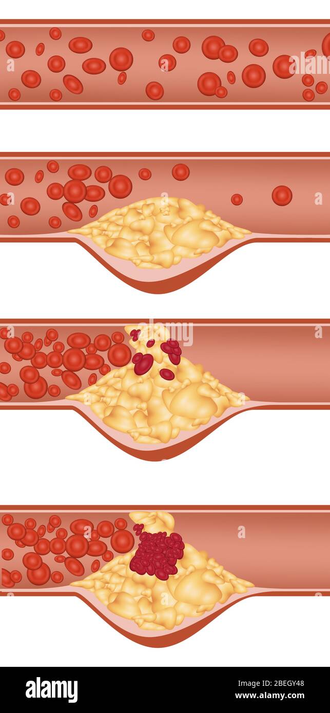 Artery Blockage High Resolution Stock Photography and Images - Alamy