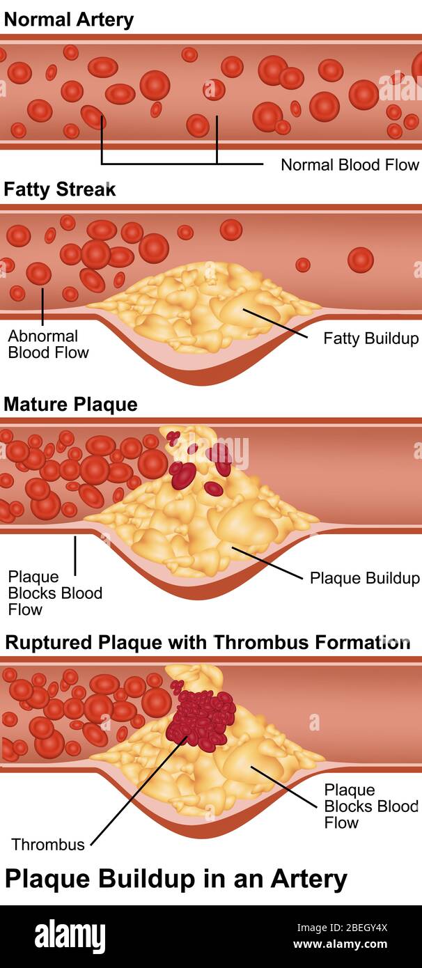 Plaque in Artery Stock Photo - Alamy