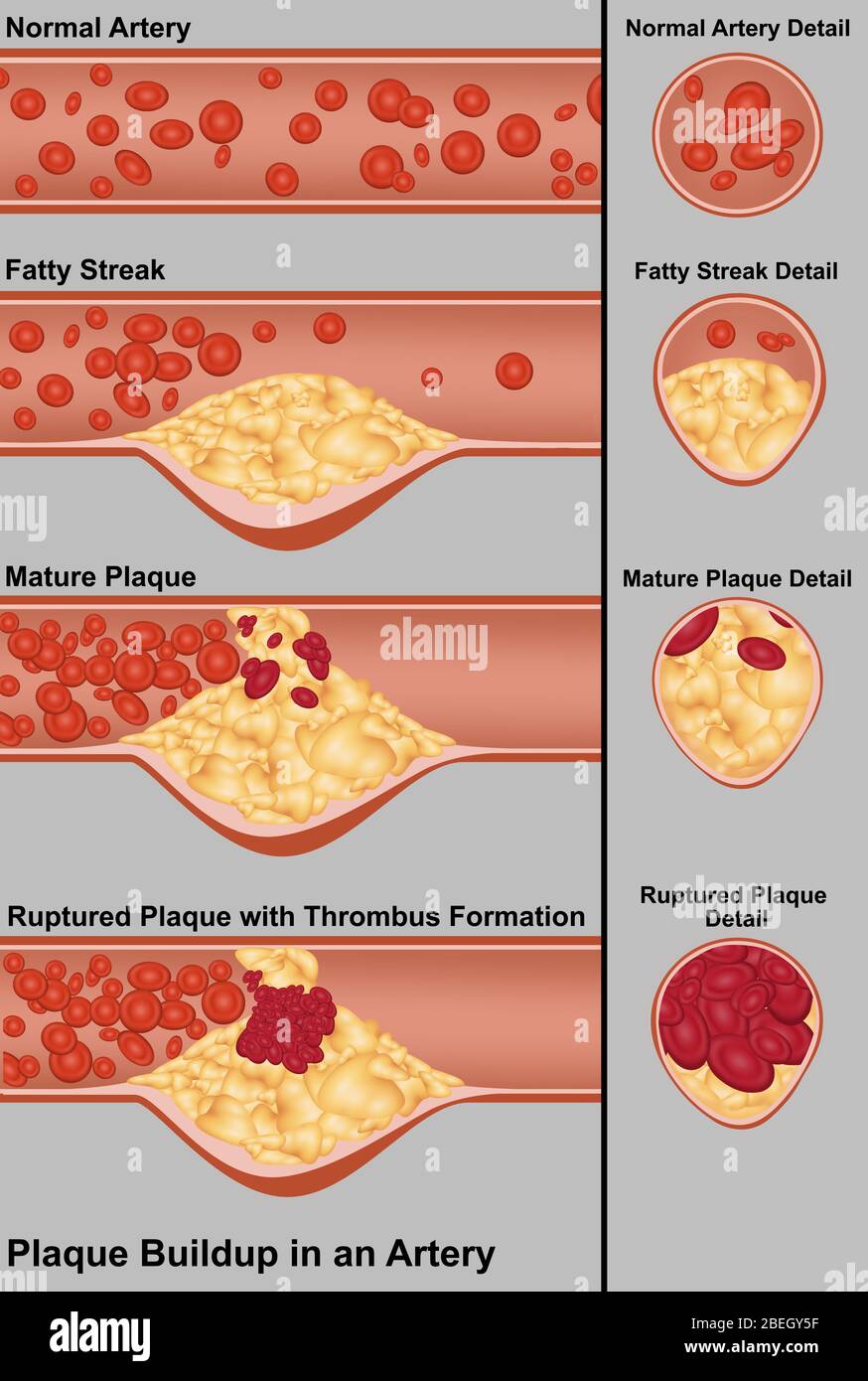 Artery plaque rupture hi-res stock photography and images - Alamy