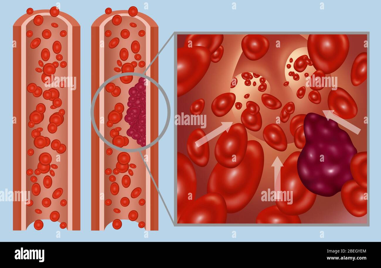 Arterial Thrombus and Embolus Stock Photo - Alamy