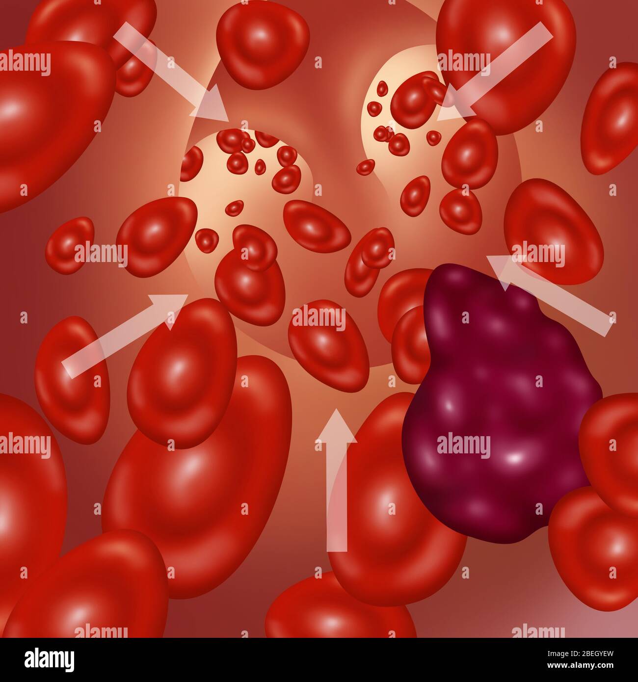 Embolus art hi-res stock photography and images - Alamy