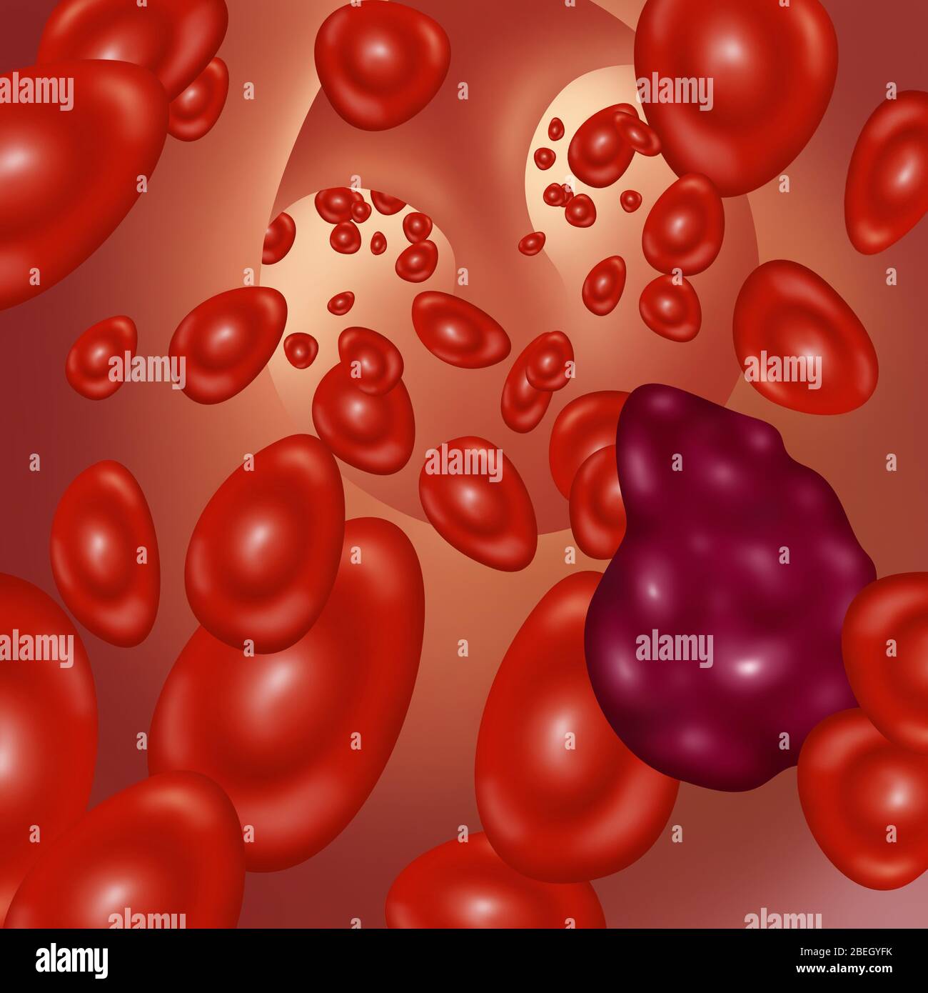 Embolus hi-res stock photography and images - Alamy