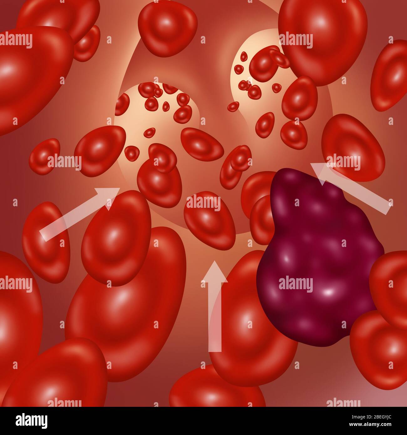 Restricted blood flow hi-res stock photography and images - Alamy