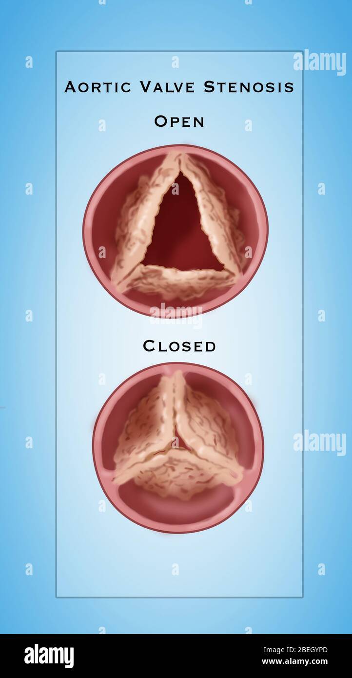 Aortic stenosis hi-res stock photography and images - Alamy