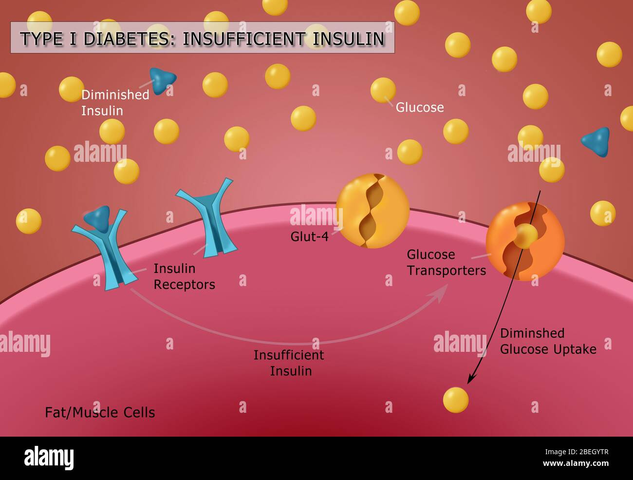 Type I Diabetes Stock Photo - Alamy