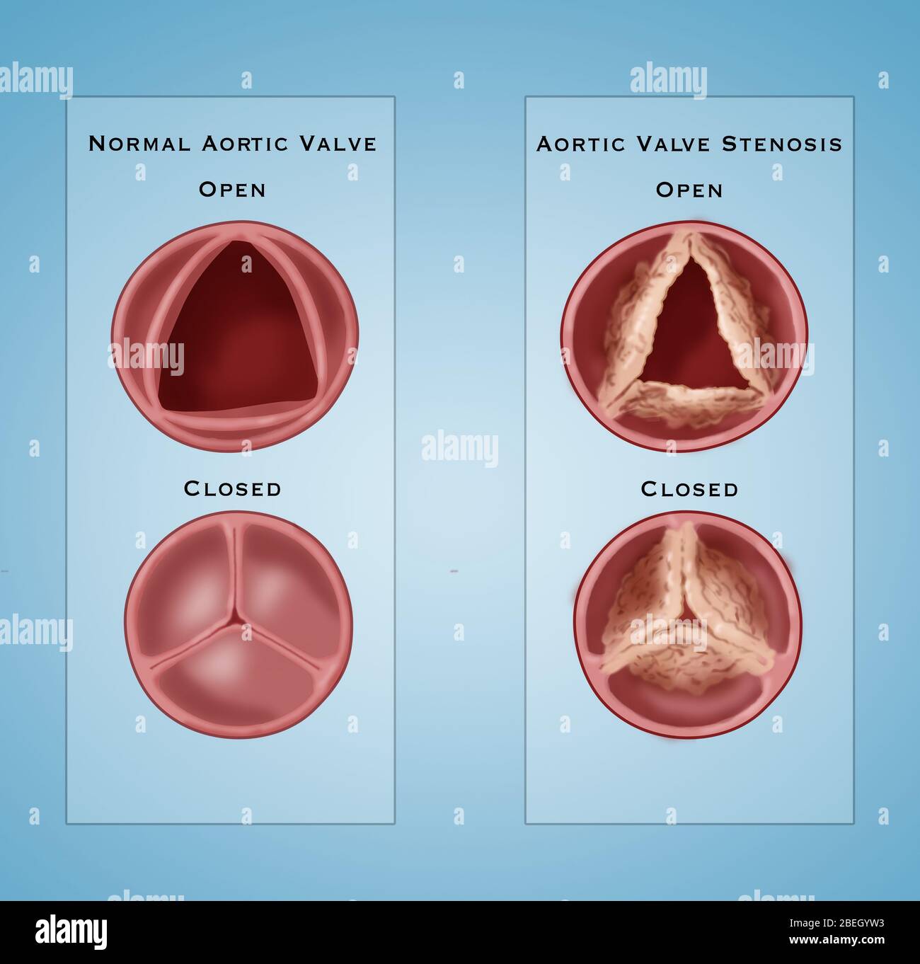 Aorta heart failure hi-res stock photography and images - Alamy