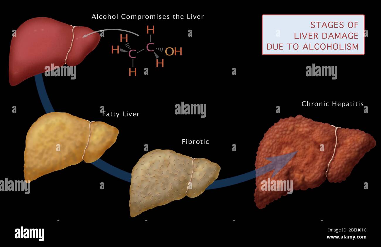 Stages of Liver Damage Stock Photo - Alamy