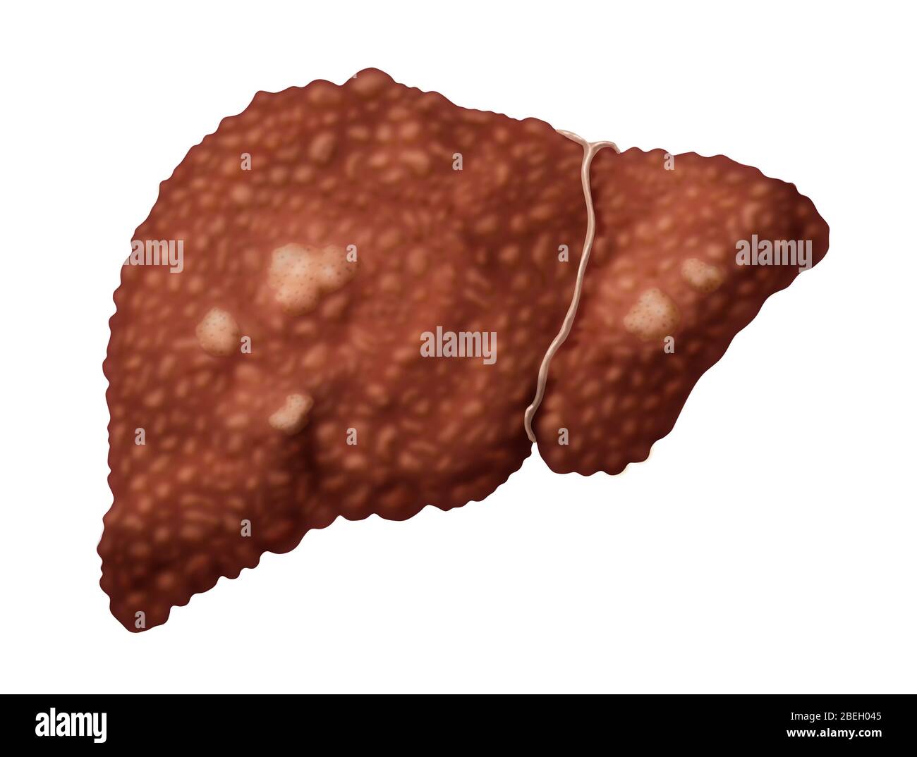 Hepatocellular damage hi-res stock photography and images - Alamy