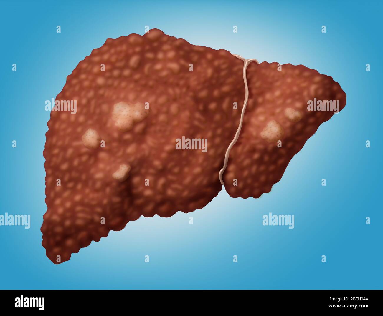 Liver cancer hepatocellular carcinoma hi-res stock photography and ...