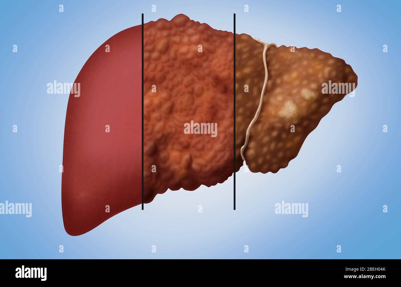 Stages of liver damage hi-res stock photography and images - Alamy