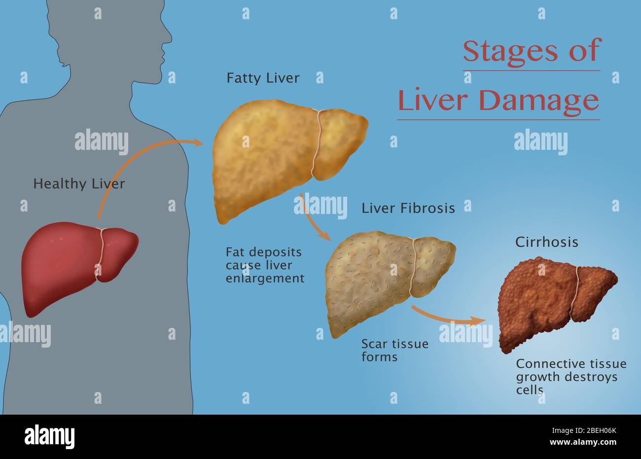 Unhealthy Liver From Alcohol