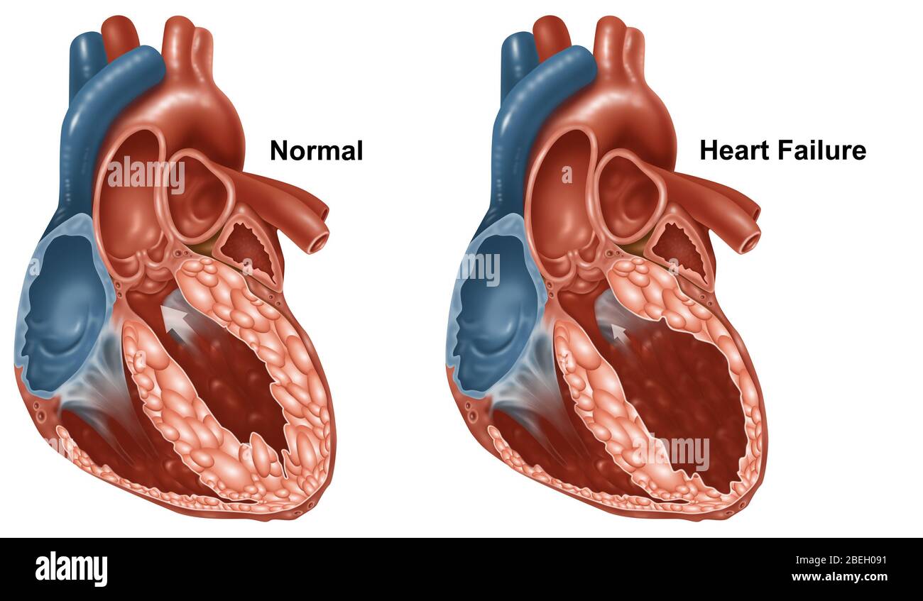 Heart failure normal heart hi-res stock photography and images - Alamy