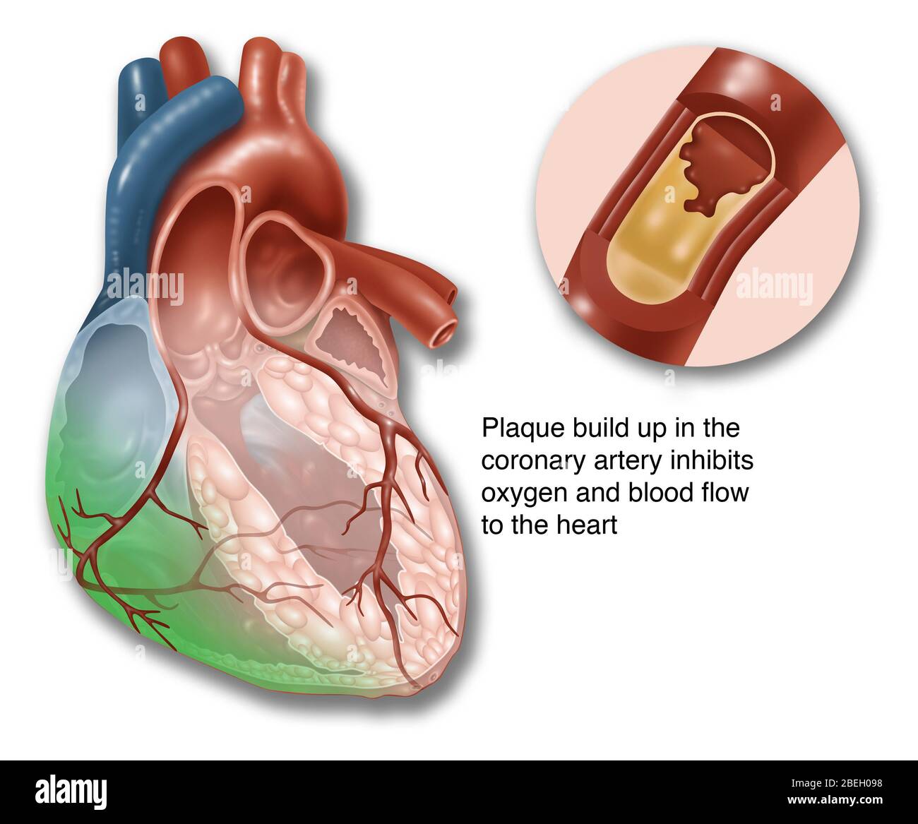 Acute Heart Failure Stock Photo - Alamy