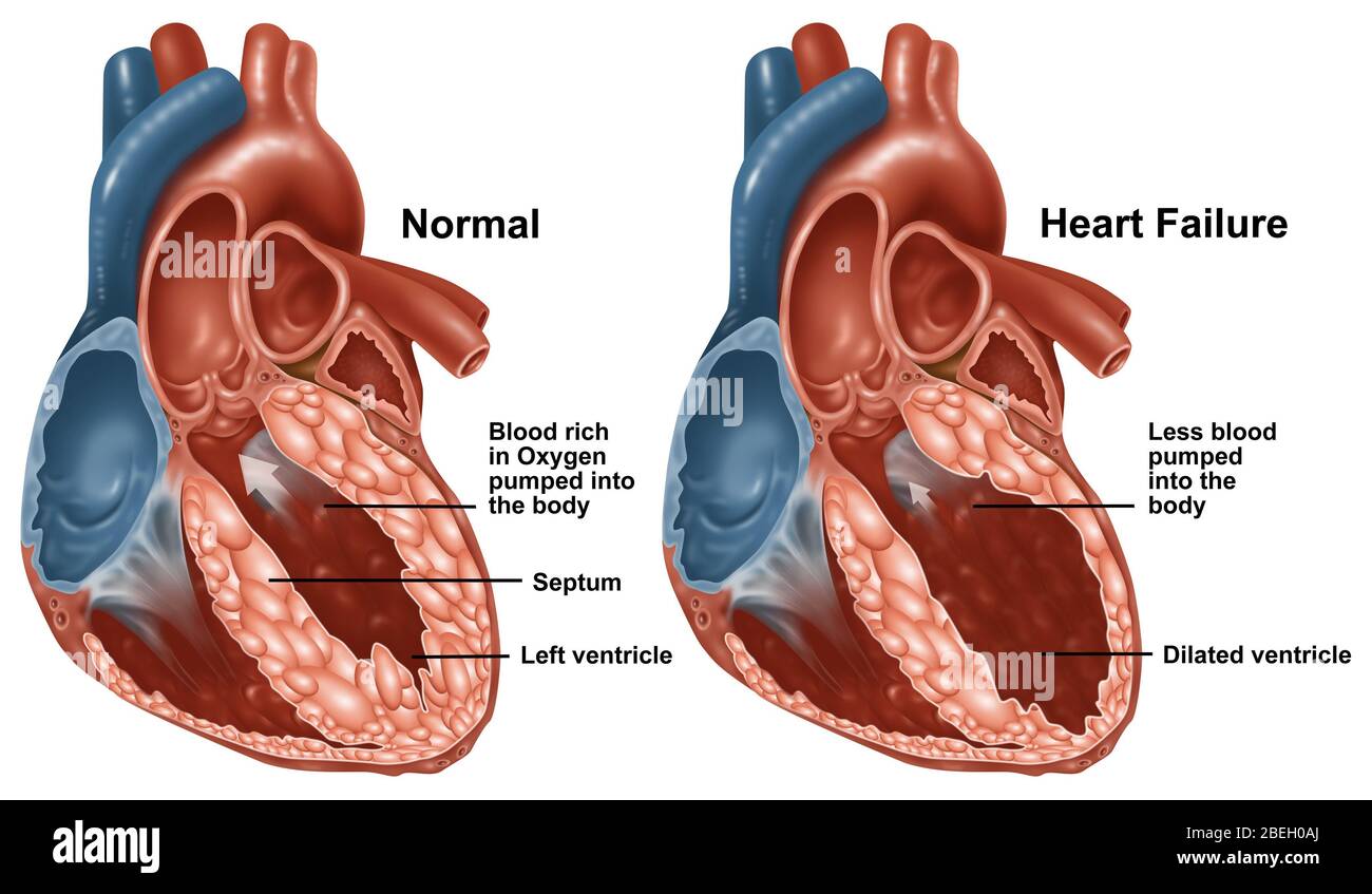 Normal and Diseased Hearts Stock Photo - Alamy