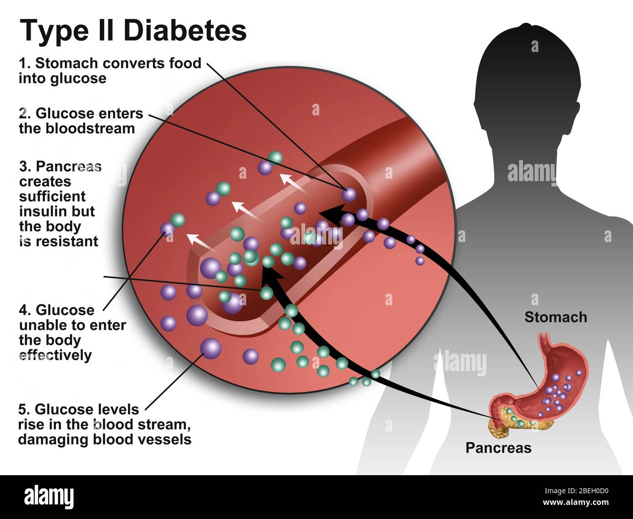 Type 2 Diabetes Graph
