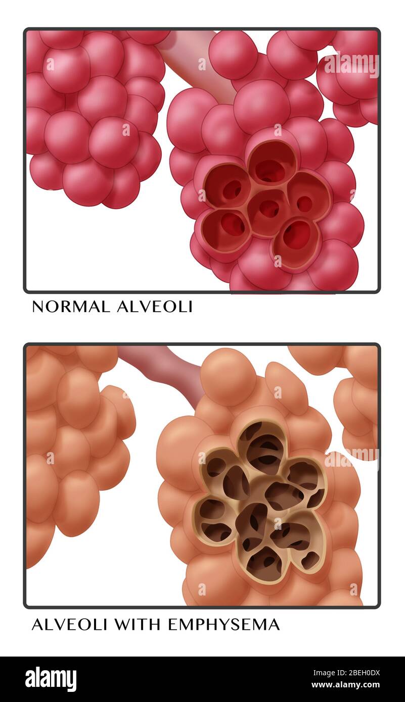 Healthy Lung Alveoli High Resolution Stock Photography and Images - Alamy