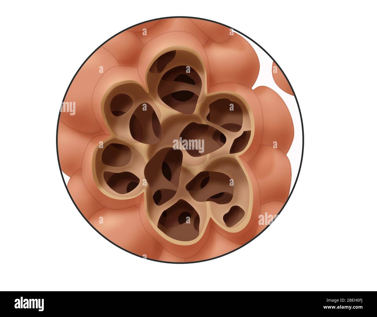 Lung emphysema damage hi-res stock photography and images - Alamy
