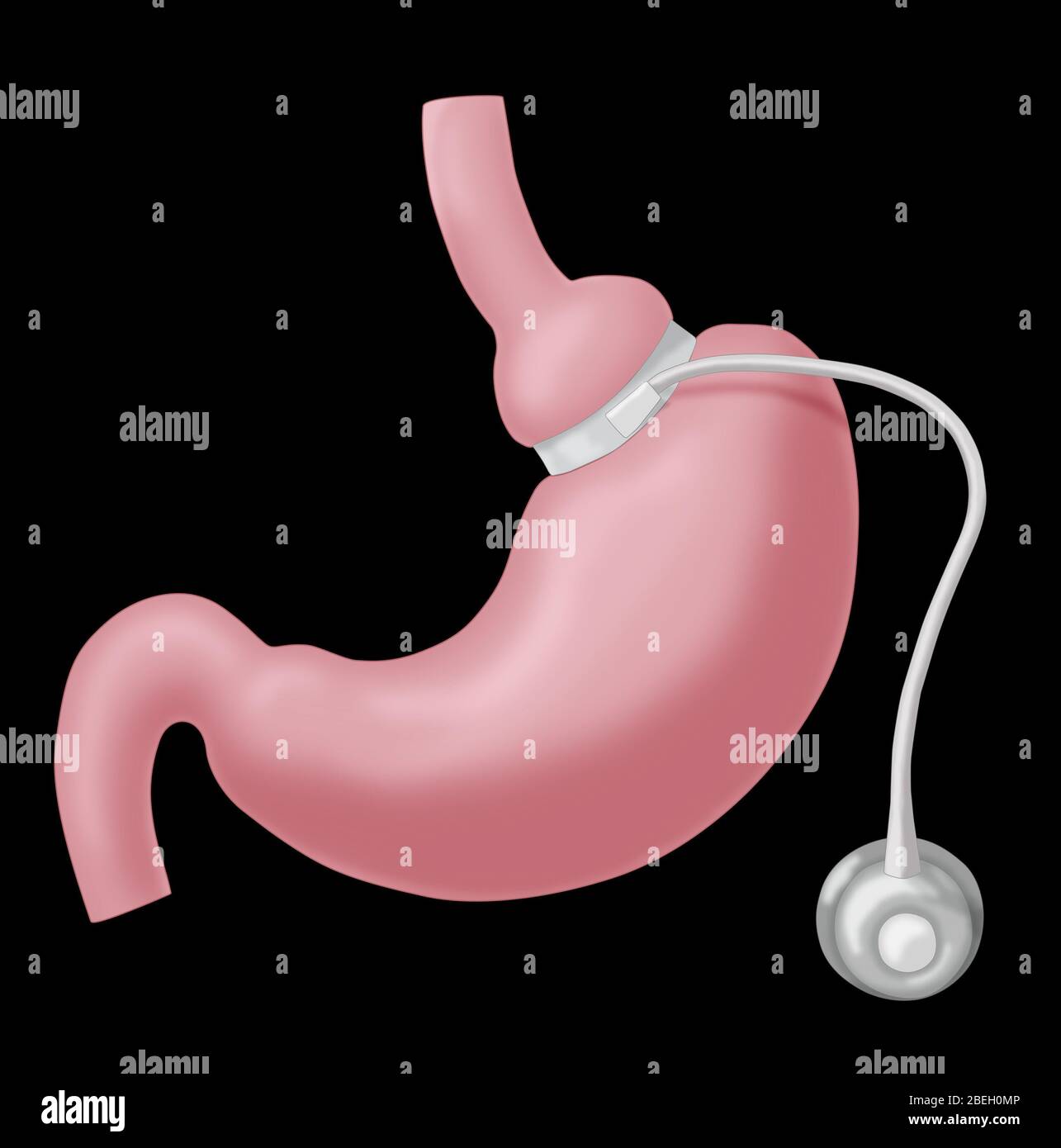 Adjustable Gastric Band Stock Photo - Alamy