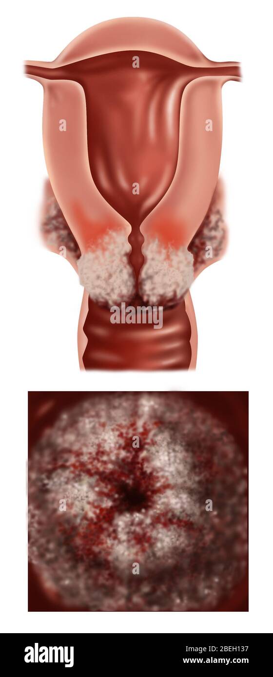 Advanced cancer Cut Out Stock Images & Pictures - Alamy