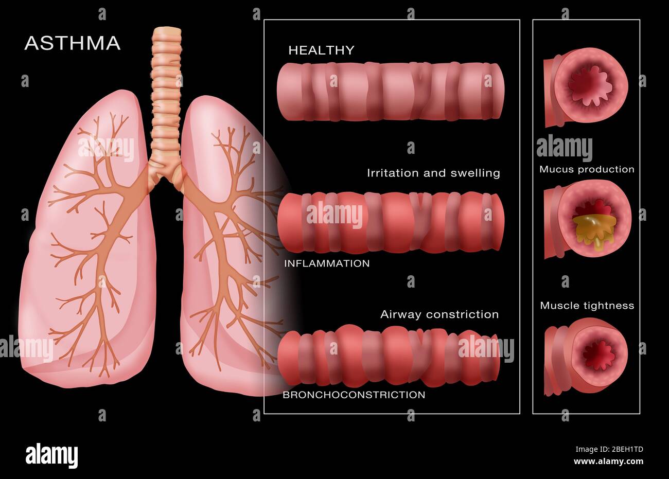 Bronchoconstriction High Resolution Stock Photography and Images - Alamy