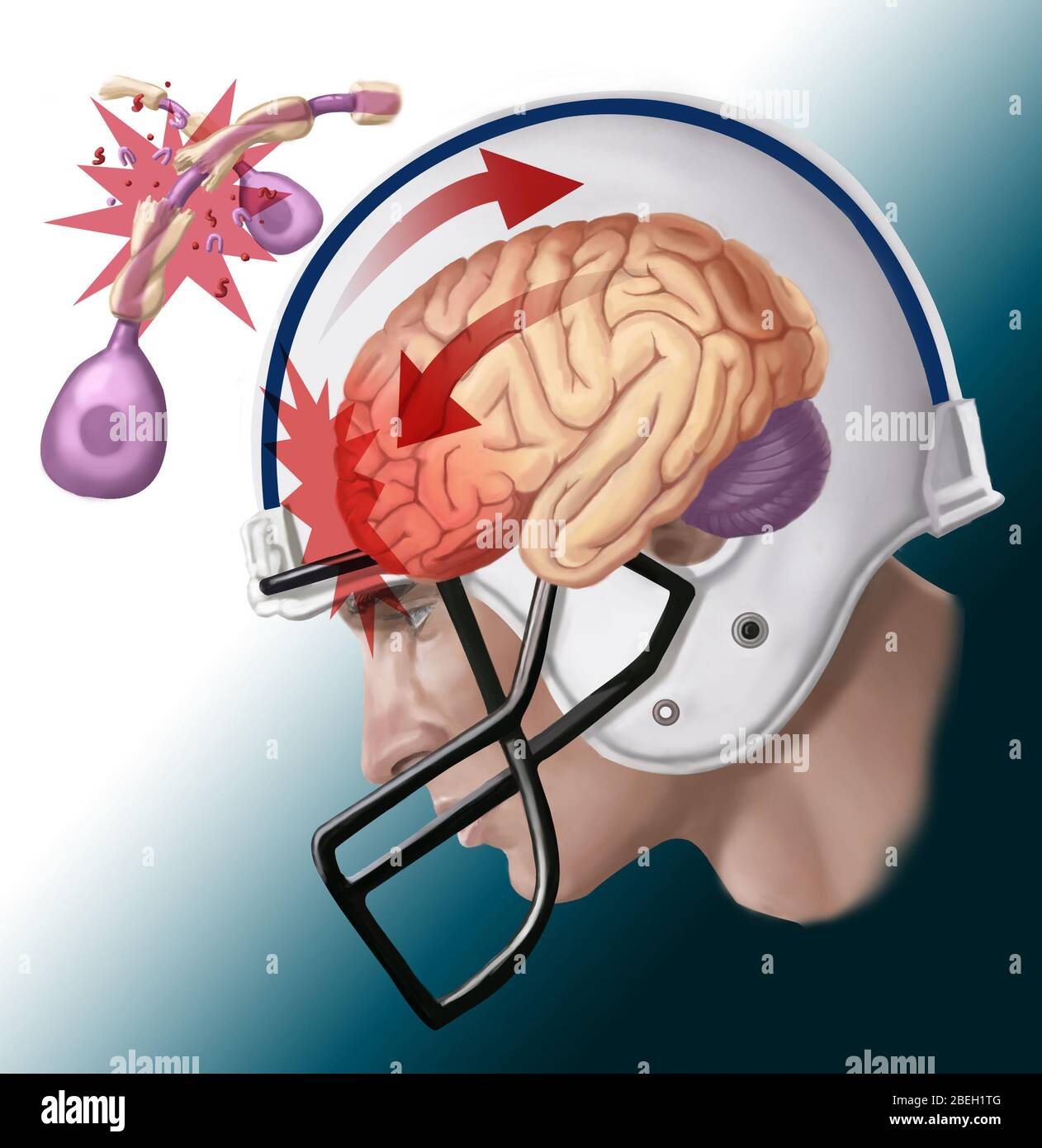 Axonal Injury from Concussion Stock Photo - Alamy