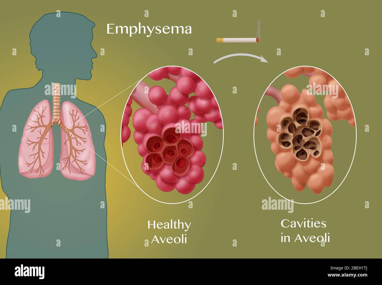 Obstructive lung disease hi-res stock photography and images - Alamy