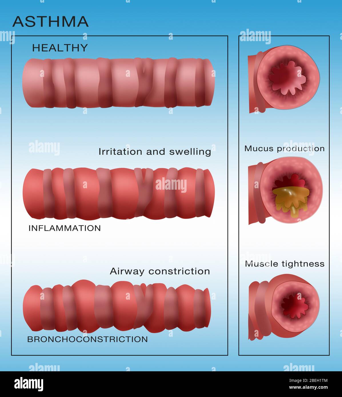 Bronchoconstriction hi-res stock photography and images - Alamy