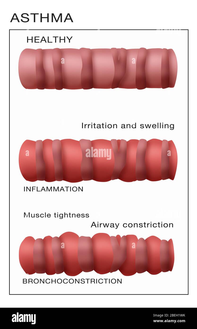 Bronchoconstriction hi-res stock photography and images - Alamy