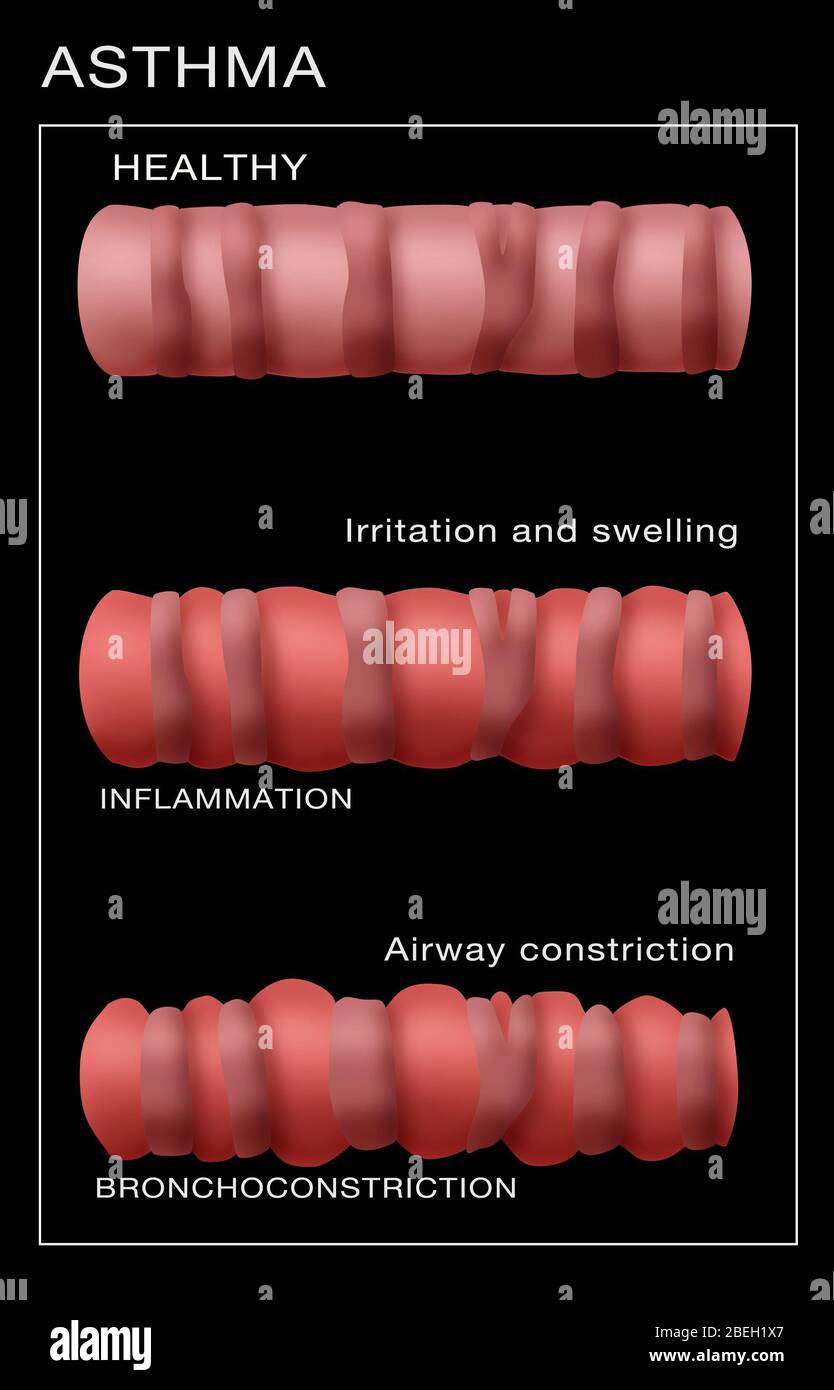 Bronchioles asthma hi-res stock photography and images - Alamy
