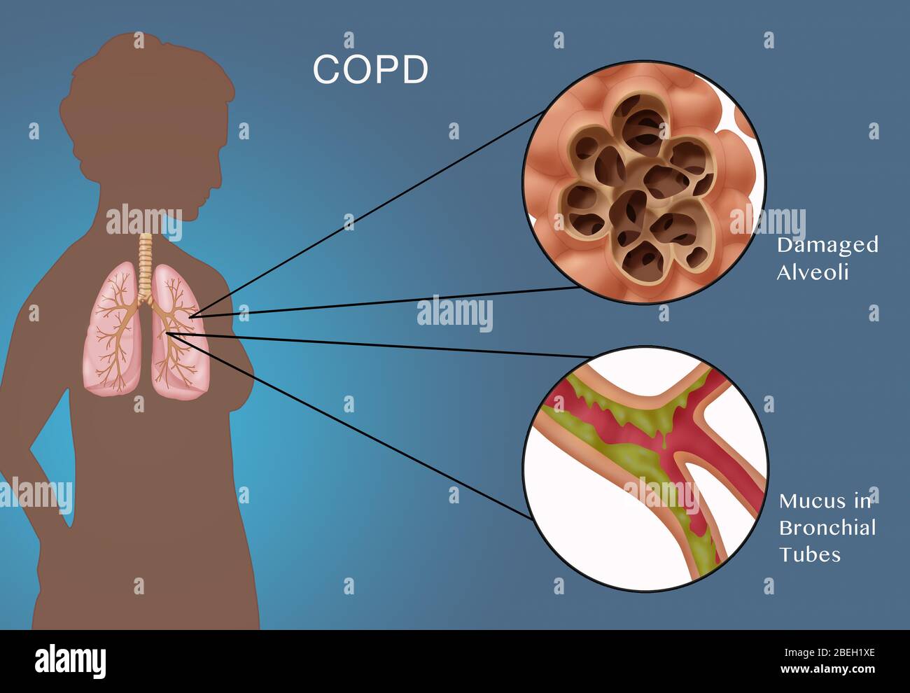 Chronic Obstructive Pulmonary Disease (COPD Stock Photo - Alamy