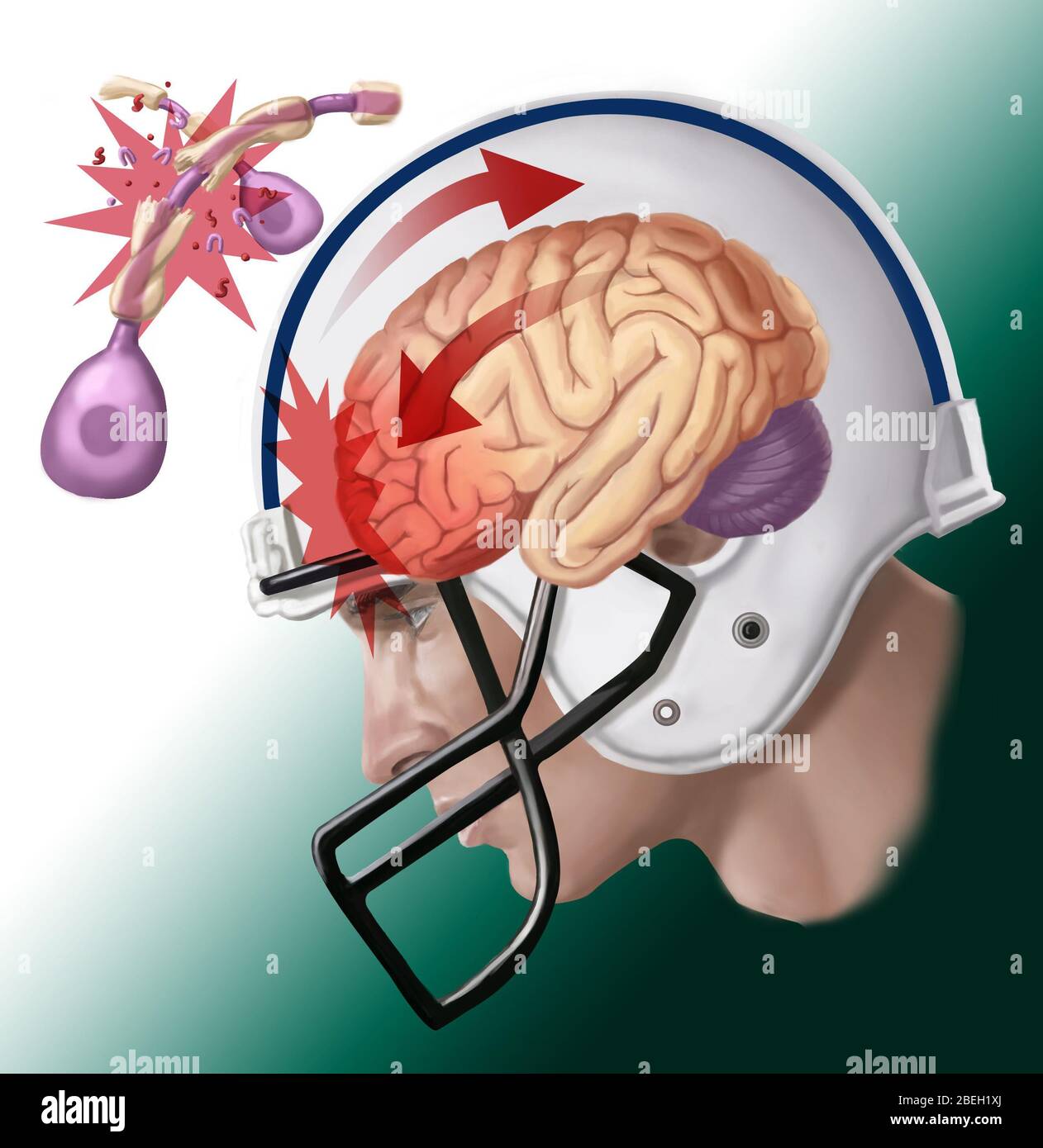 Axonal Injury from Concussion Stock Photo - Alamy