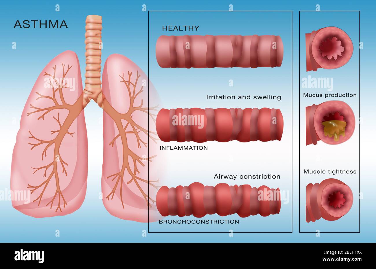 Bronchial asthma lung hi-res stock photography and images - Alamy