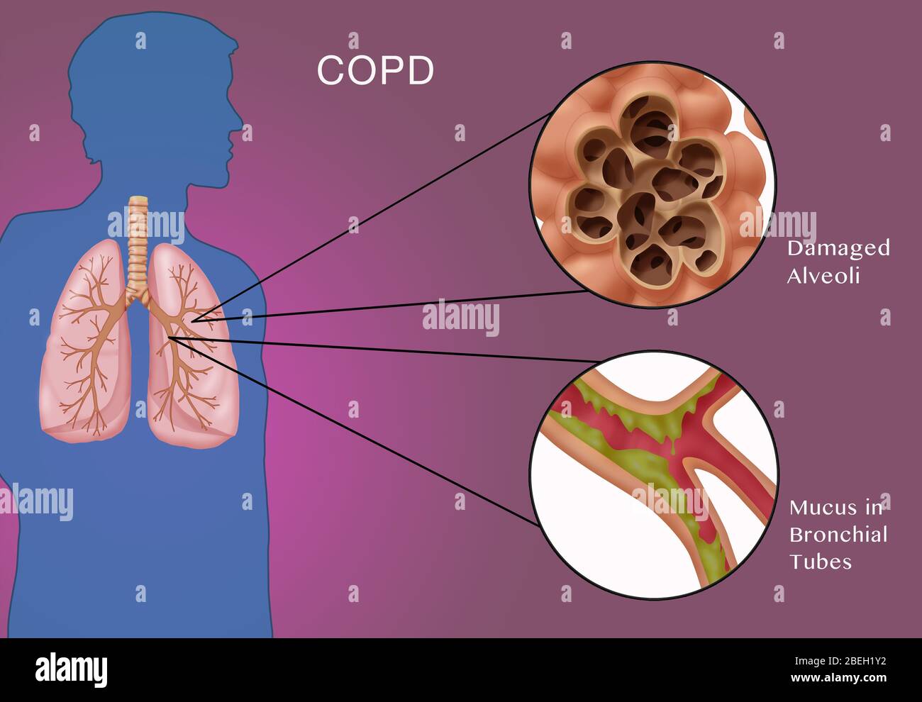 Chronic Obstructive Pulmonary Disease (COPD Stock Photo - Alamy