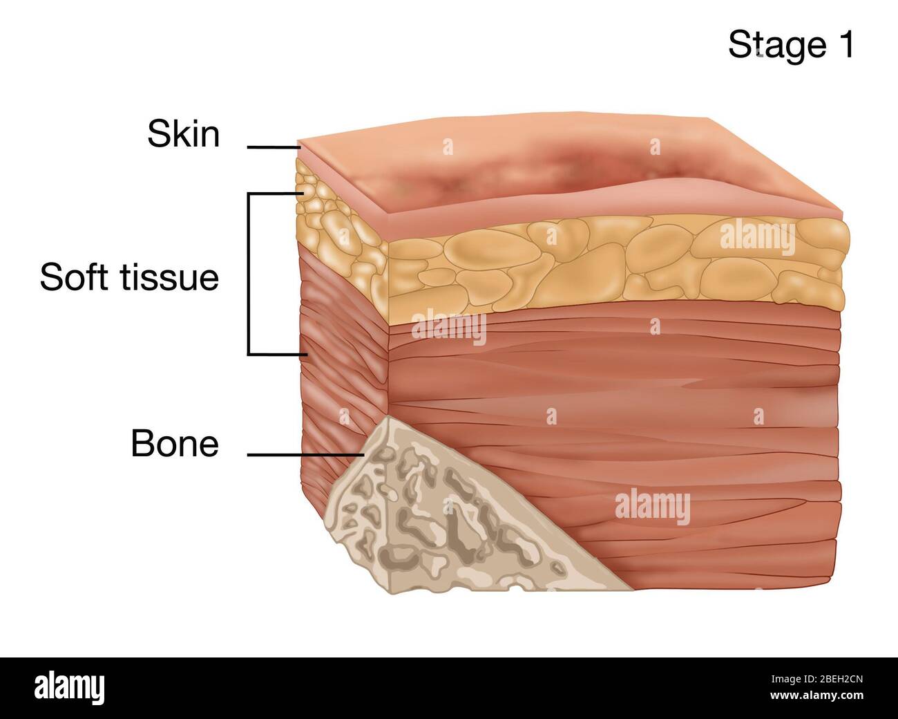 Pressure Ulcers Animation