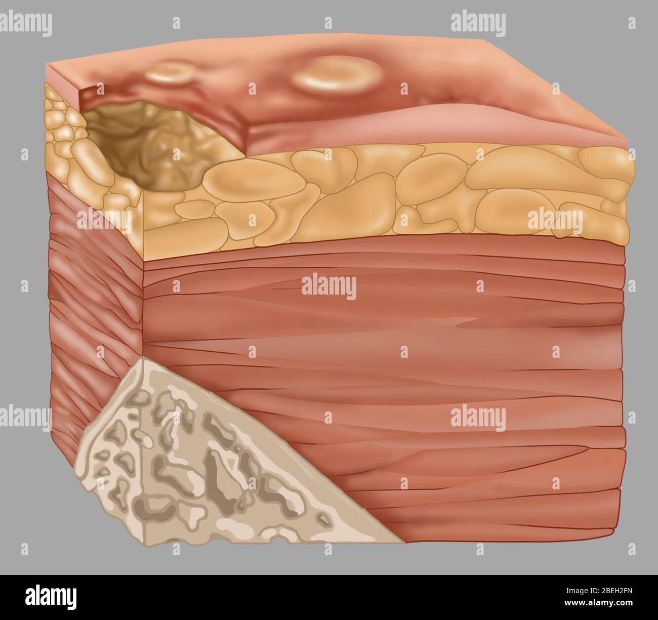 Pressure Ulcer Stage 2