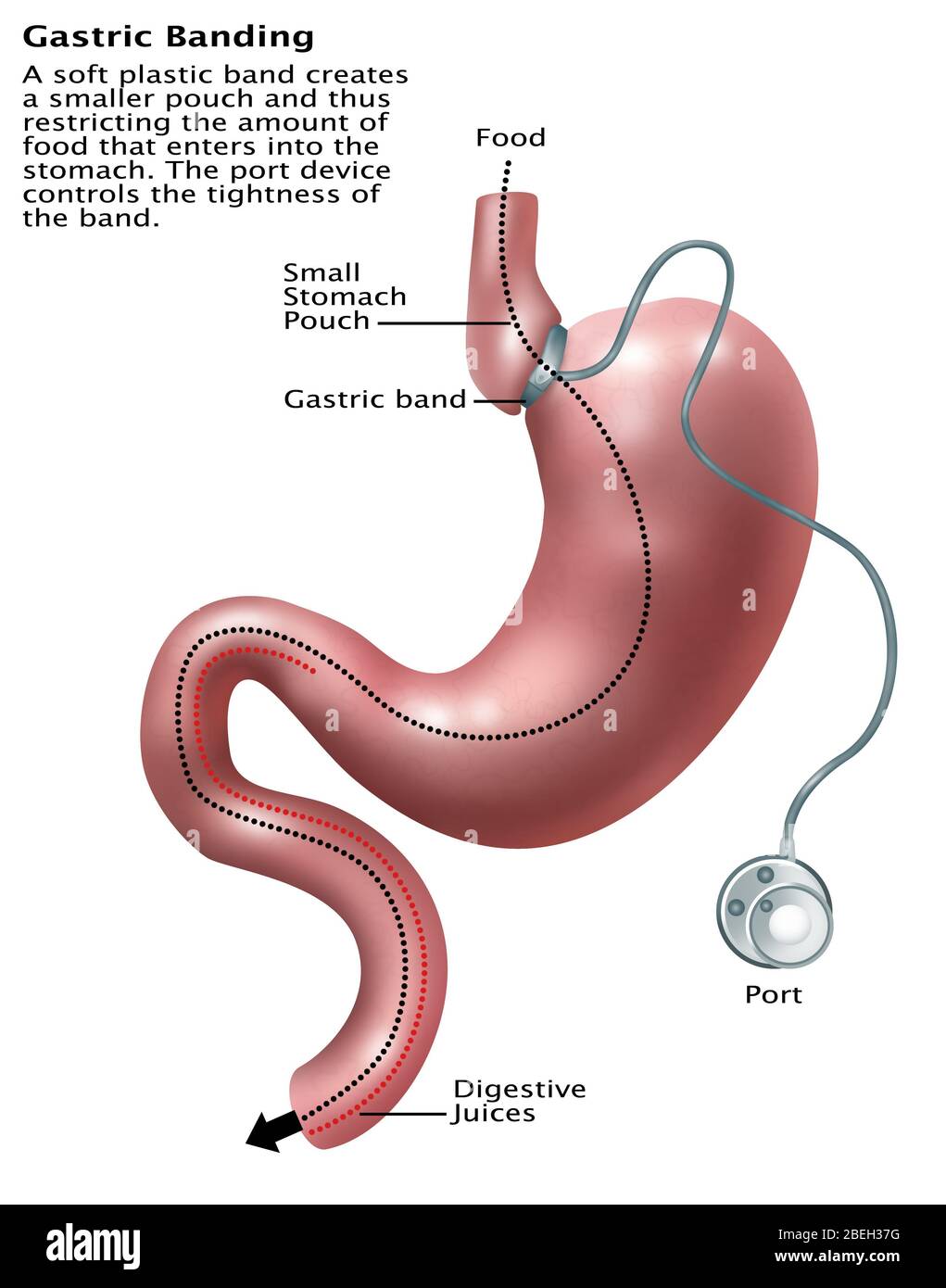 Gastric banding hi-res stock photography and images - Alamy