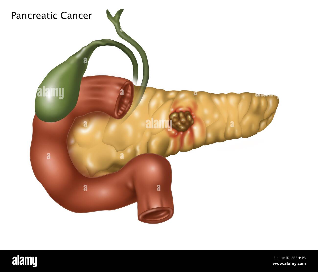 Pancreatic Cancer, Illustration Stock Photo - Alamy