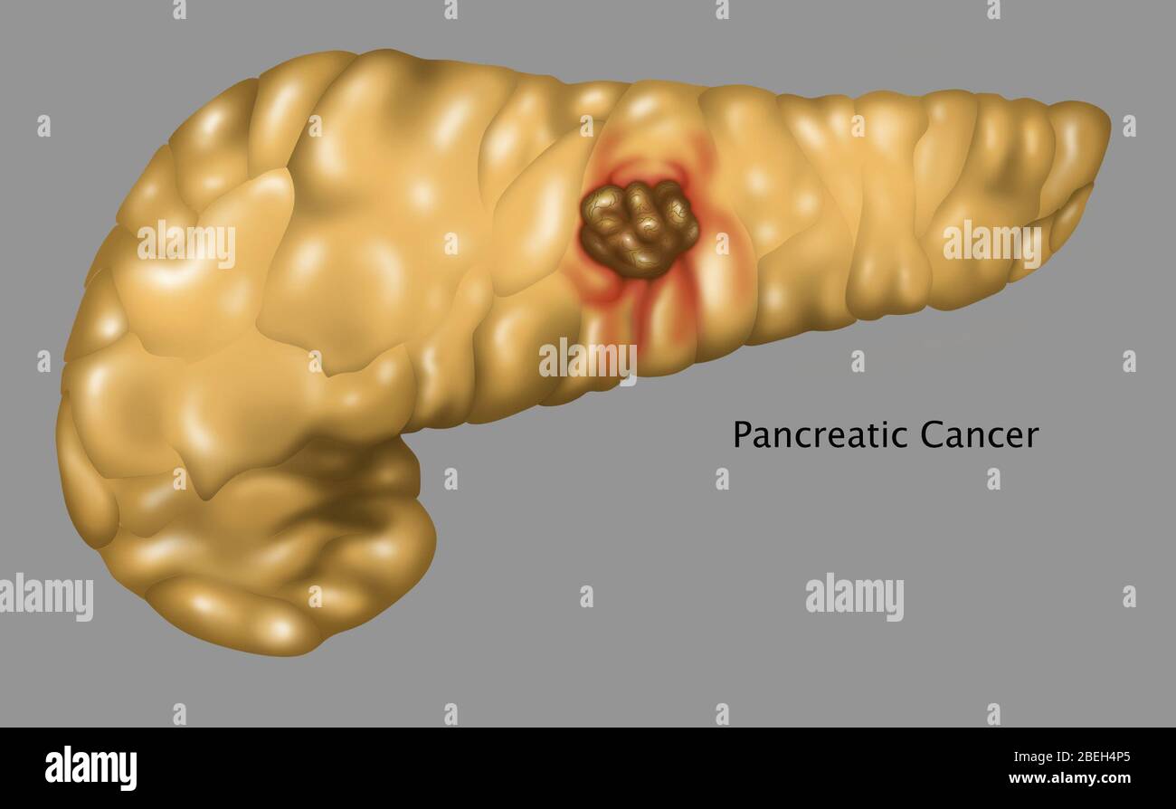 Pancreatic Cancer, Illustration Stock Photo - Alamy