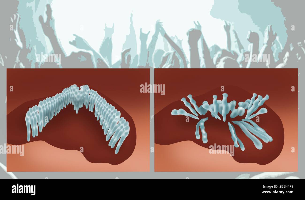 Noise-Induced Hearing Loss Stock Photo - Alamy Noise-Induced Hearing Loss Stock Photo - Alamy