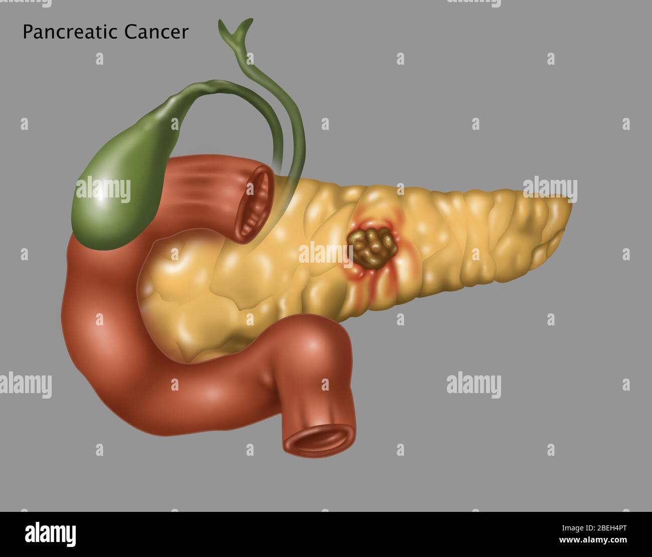 Pancreatic Cancer, Illustration Stock Photo - Alamy