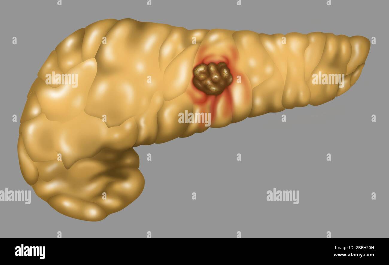 Pancreatic Cancer, Illustration Stock Photo - Alamy