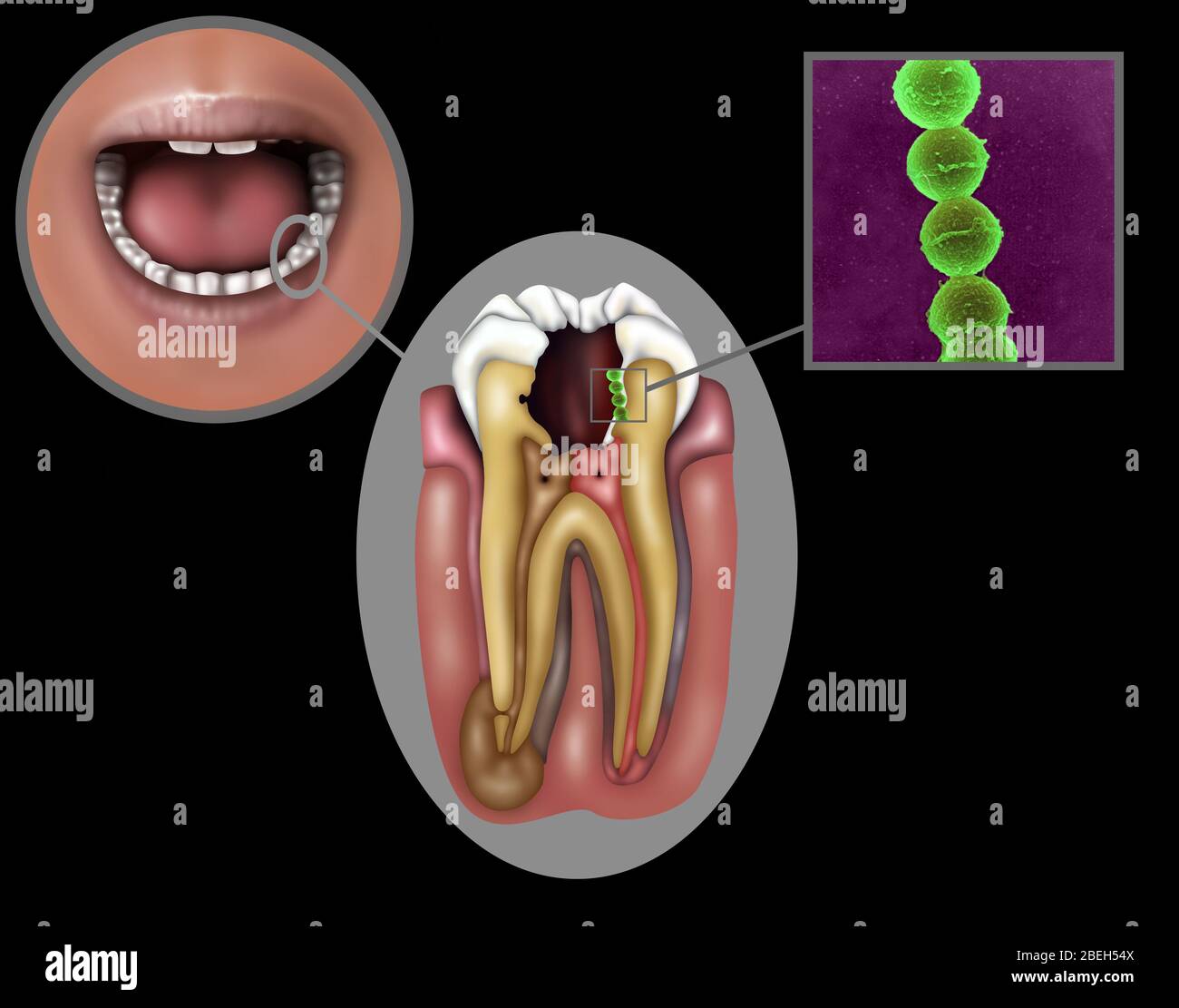 Streptococcus oralis hi-res stock photography and images - Alamy
