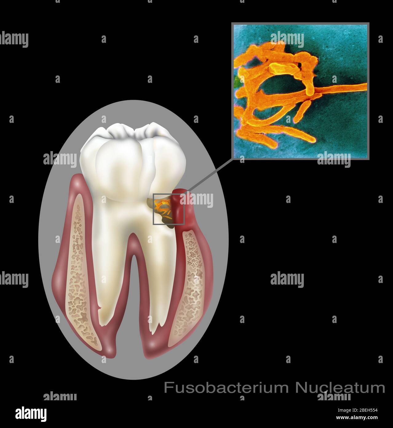 Oral Infection of Fusobacterium Nucleatum Stock Photo - Alamy