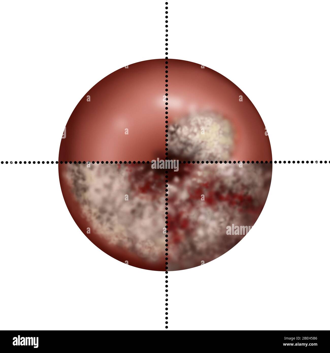 Cervical cancer progression Cut Out Stock Images & Pictures - Alamy