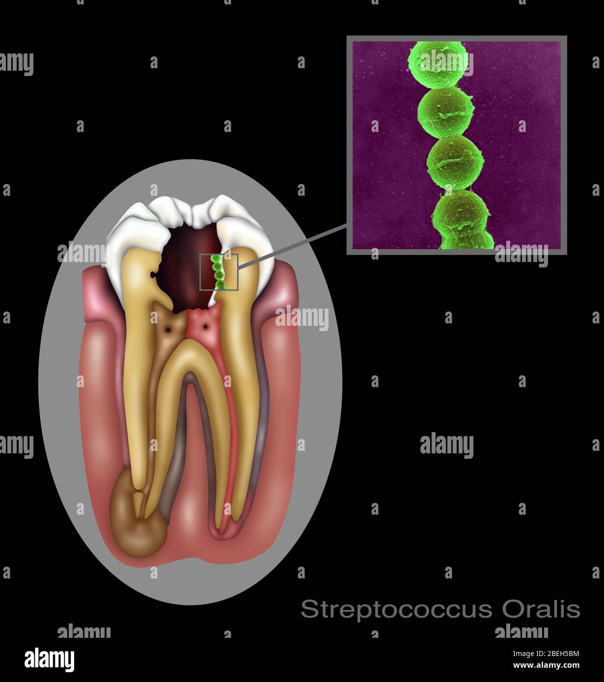 Oral Infection of Streptococcus Oralis Stock Photo - Alamy
